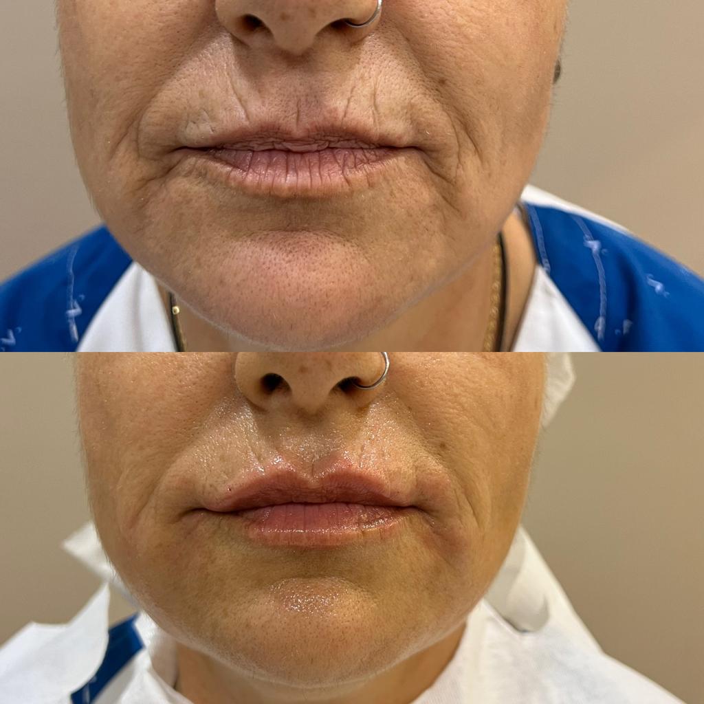 CASO CORRECCIÓN SURCO NASOGENIANO, MARIONETAS, LABIOS Y CÓDIGO DE ...